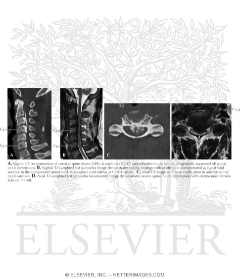 Imaging of Ossification of Posterior Longitudinal Ligament (OPLL)