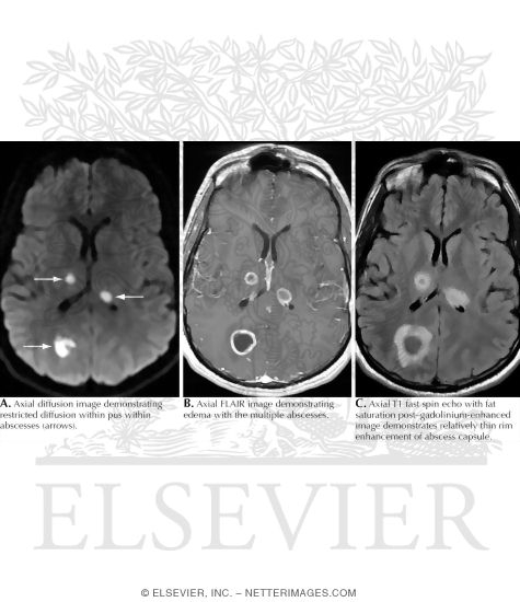 Multiple Brain Abscesses In a 32-Year-Old With Septicemia