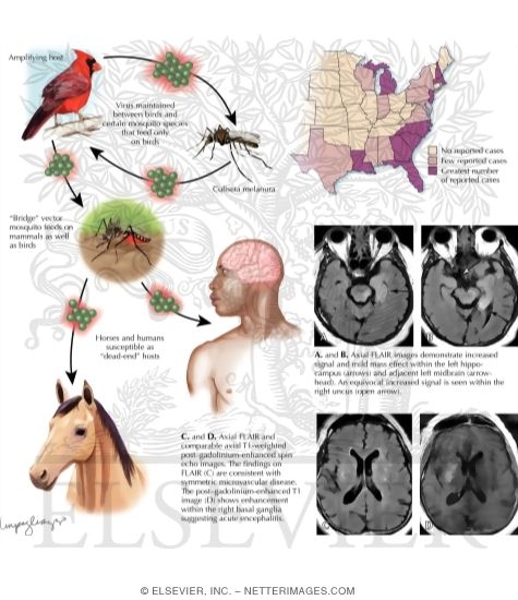 Eastern Equine Encephalitis