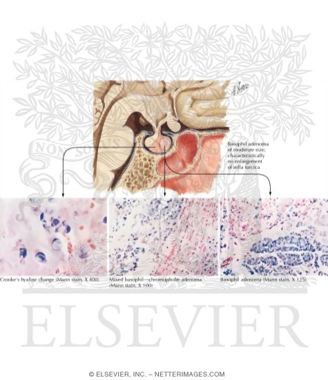 Basophilic Adenoma Cushing Disease