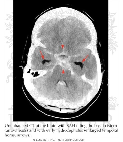 Basilar Artery Tip Aneurysmal Bleed