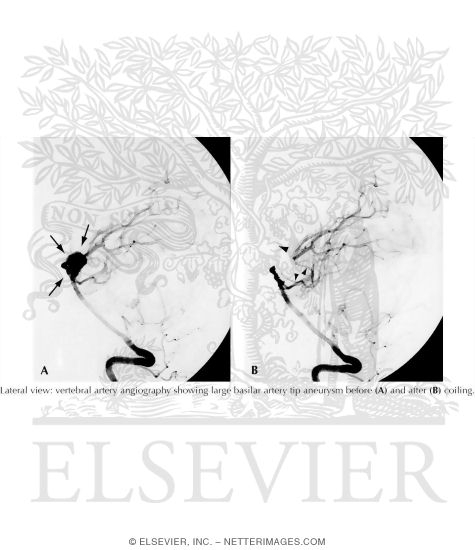 Basilar Artery Tip Aneurysm