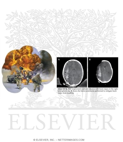 Brain Injury In Military Combat