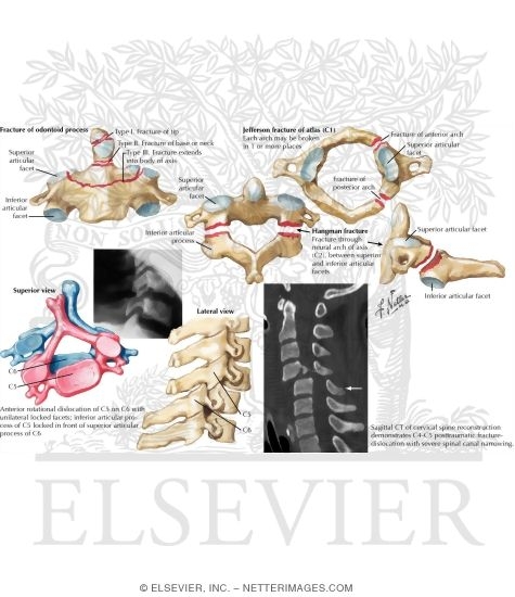 Fracture and Dislocation of Cervical Vertebrae