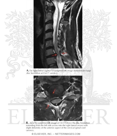 Large Right Lateral C6-C7 Disc Herniation