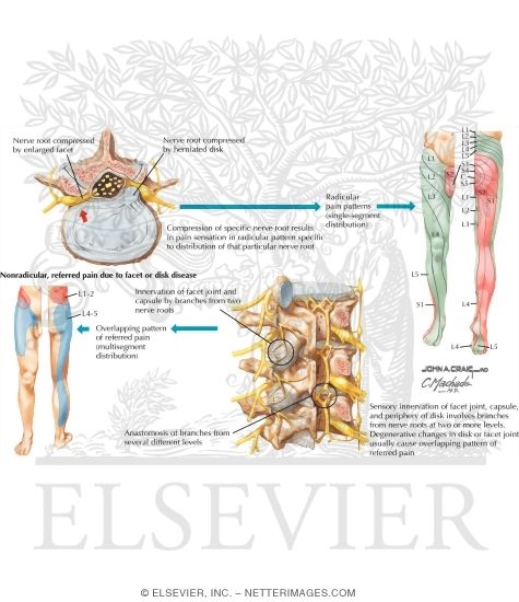 Pain Patterns in Lumbar Disease