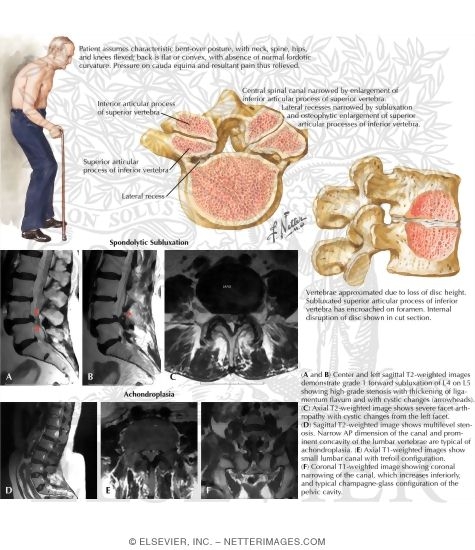 Lumbar Spinal Stenosis