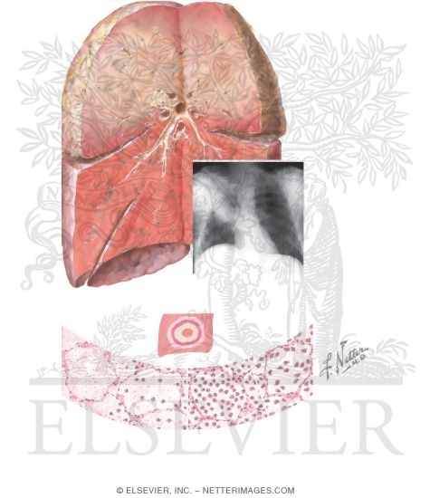 Pneumococcal Pneumonia