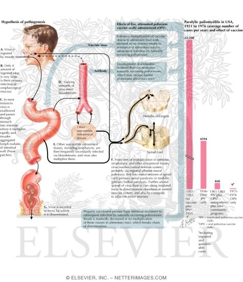Poliomyelitis