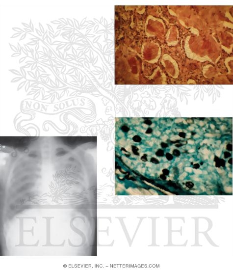 Pneumocystis Pneumonia