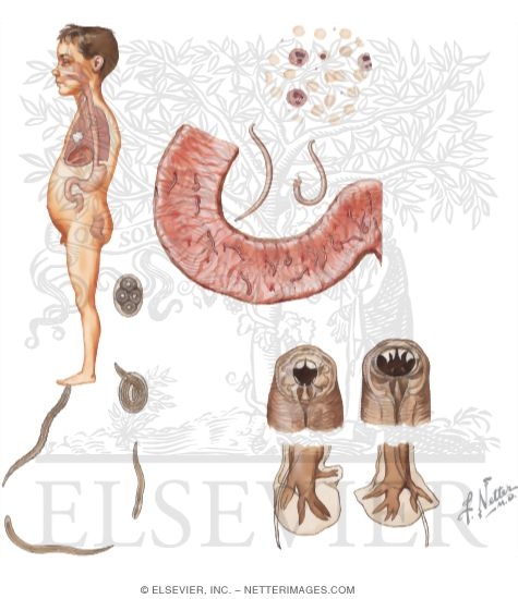 human hookworm infection