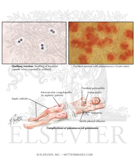 Pneumococcal Disease