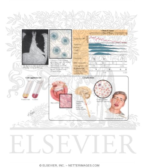 Mycoplasmal (Eaton Agent) Pneumonia (primary Atypical Pneumonia)