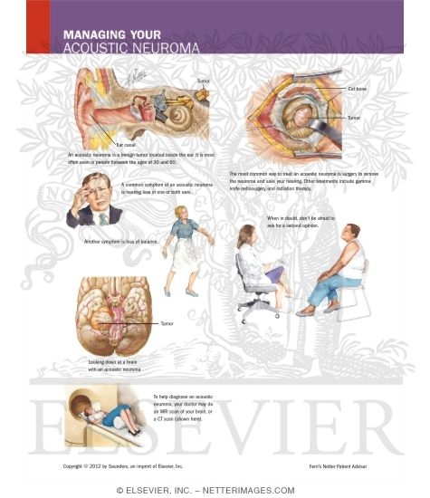 Managing Your Acoustic Neuroma