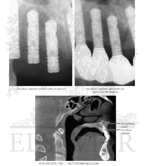 Surgical Procedures: Maxillary Implants