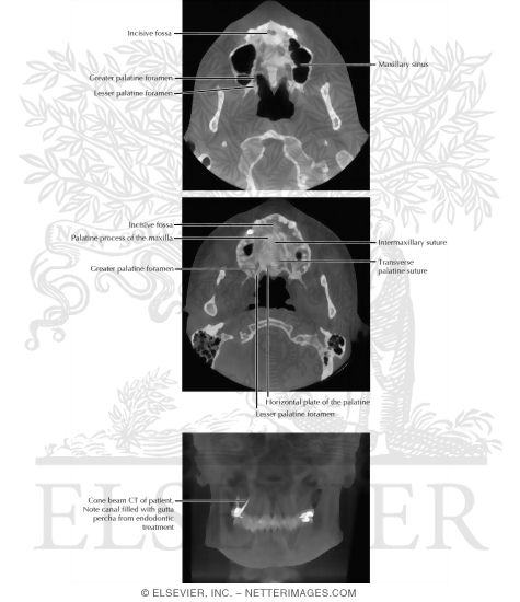Tonsilitis: Imaging