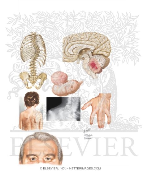 Basal Cell Nevus Syndrome