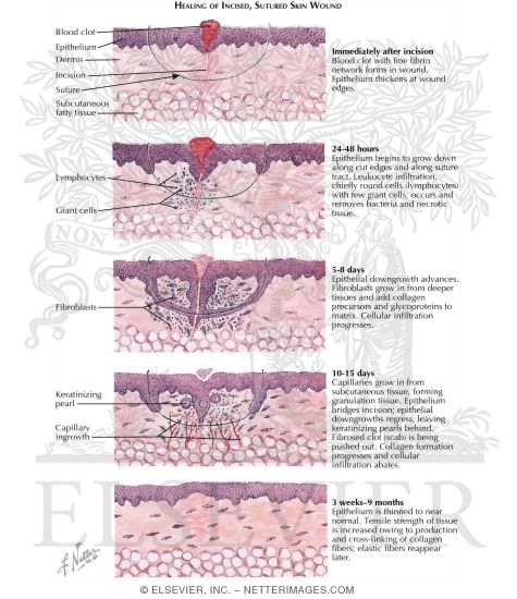 Healing of Incised, Sutured Skin Wound