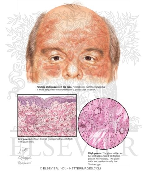 Necrobiotic Xanthogranuloma