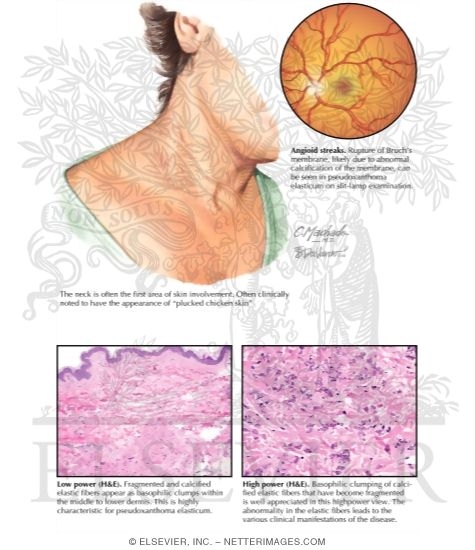 Pseudoxanthoma Elasticum