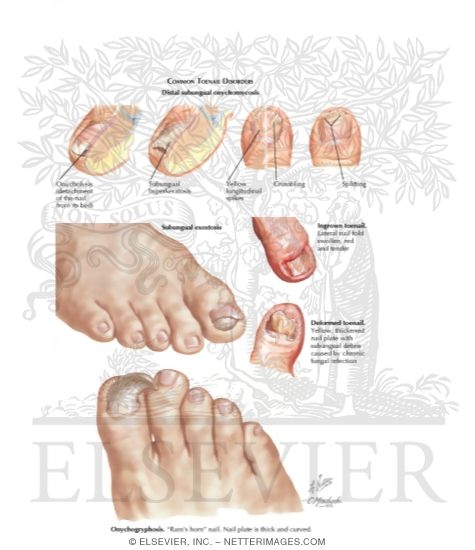 Common Nail Disorders (Continued)