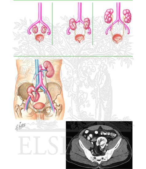 Renal Ascent and Ectopia: Normal Renal Ascent and Pelvic Kidney