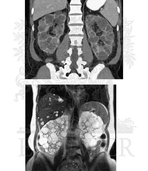 Polycystic Kidney Disease: Radiographic Findings