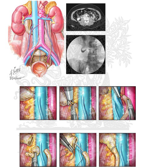 Retrocaval Ureter: Radiographic Findings and Laproscopic Repair