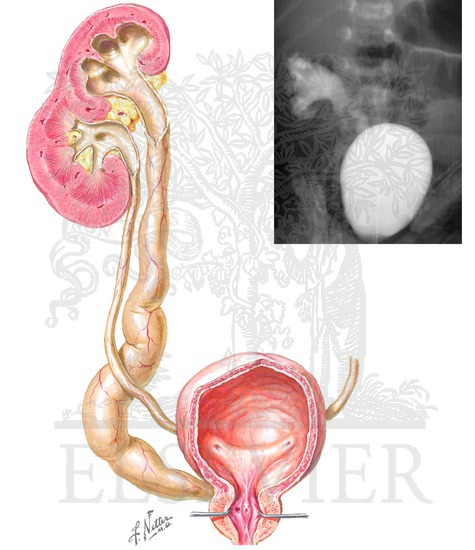Ureteral Duplication: Complete
