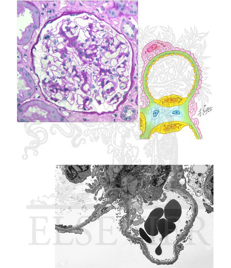 Minimal Change Disease: Histopathologic Findings