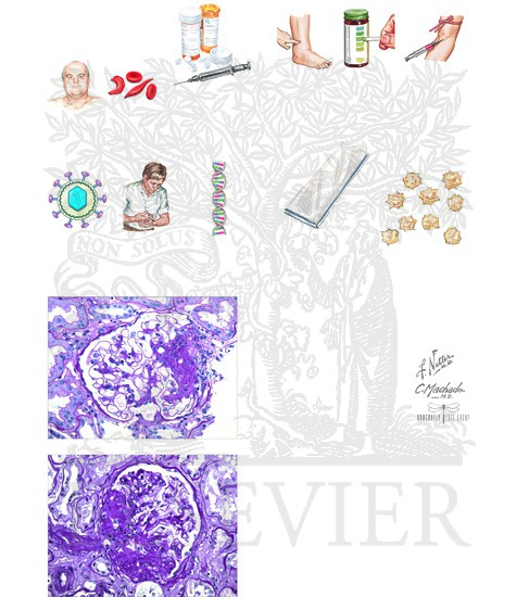 glomerulosclerosis causes