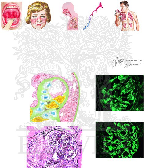 Rapidly Progressive Glomerulonephritis