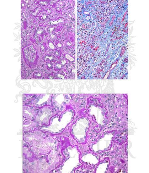 Chronic Tubulointerstitial Nephritis: Histopathologic Findings