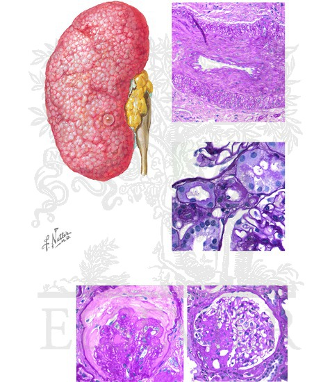 malignant hypertension
