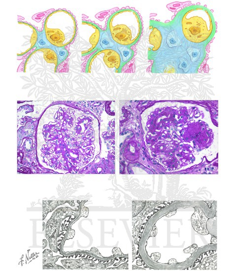 Diabetic Nephropathy