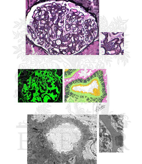 Lupus Nephritis: Renal Histopathology (Class V Lesions)
