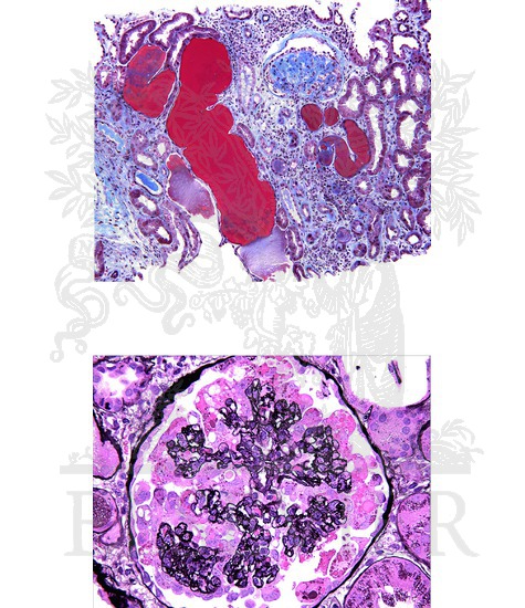HIV-Associated Nephropathy: Light Microscopy Findings