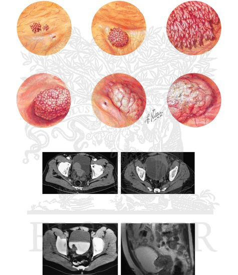 Tumors of the Bladder: Cystoscopic and Radiographic Appearance
