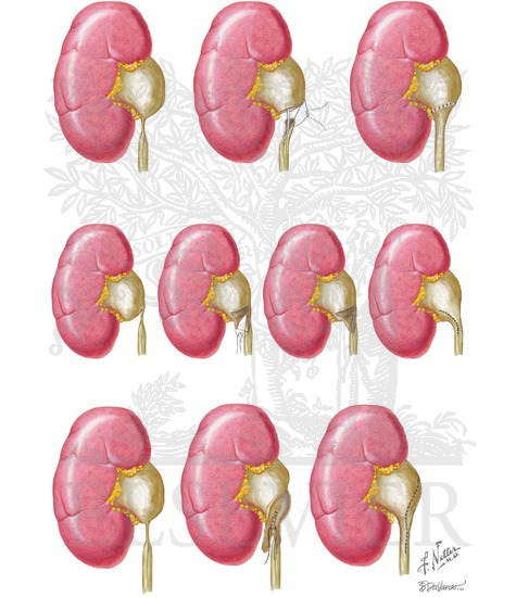 Pyeloplasty and Endopyelotomy