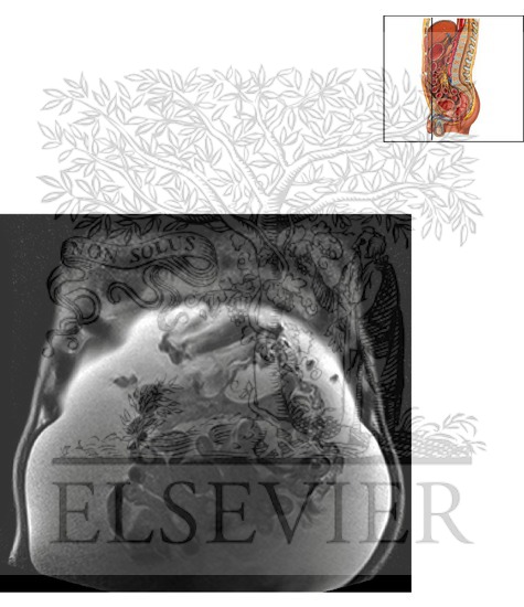 Peritoneal Cavity Abdomen Coronal 2