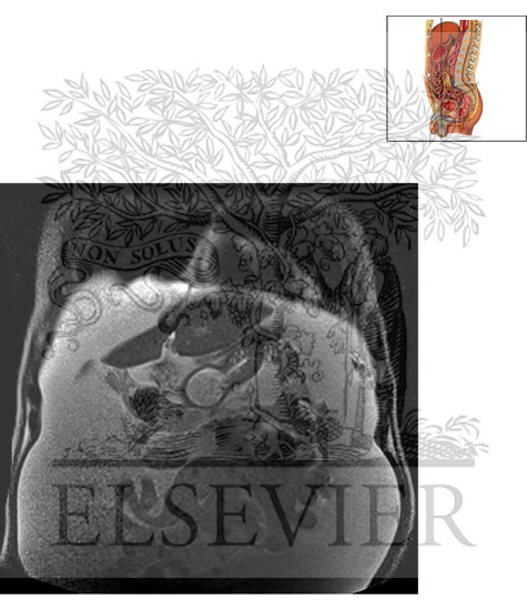 Peritoneal Cavity Abdomen Coronal 3