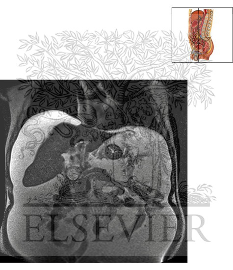 Peritoneal Cavity Abdomen Coronal 5