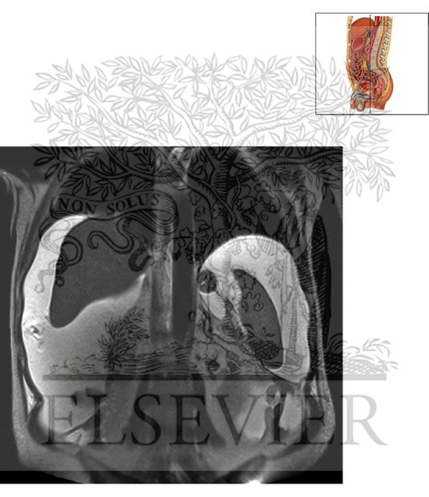 Peritoneal Cavity Abdomen Coronal 8