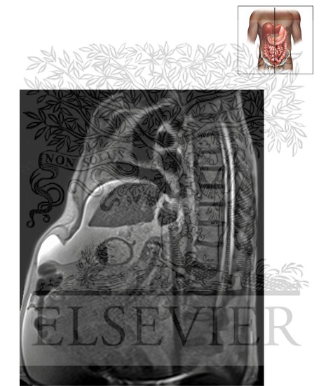 Peritoneal Cavity Pelvis Sagittal 5