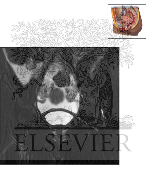 Peritoneal Cavity Pelvis Coronal 3