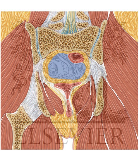 Peritoneal Cavity Pelvis Coronal 7