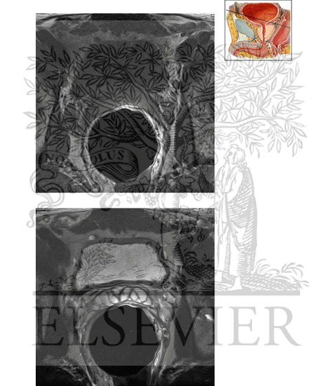 Prostate and Seminal Tract Axial 4