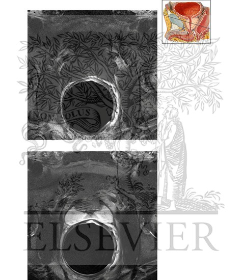 Prostate and Seminal Tract Axial 7