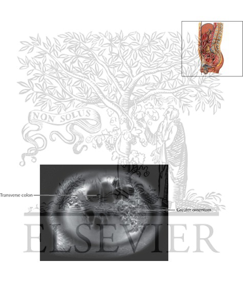 Peritoneal Cavity Abdomen Coronal 1