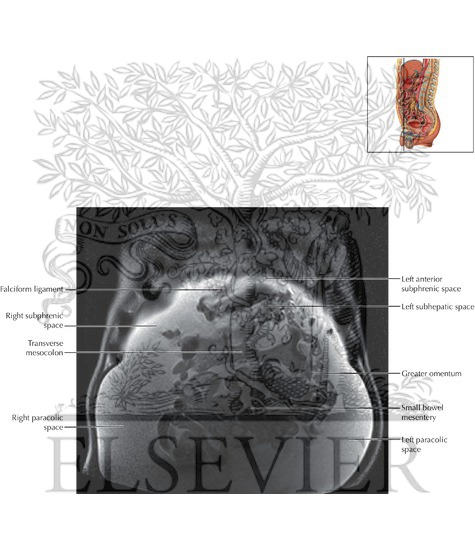 Peritoneal Cavity Abdomen Coronal 2